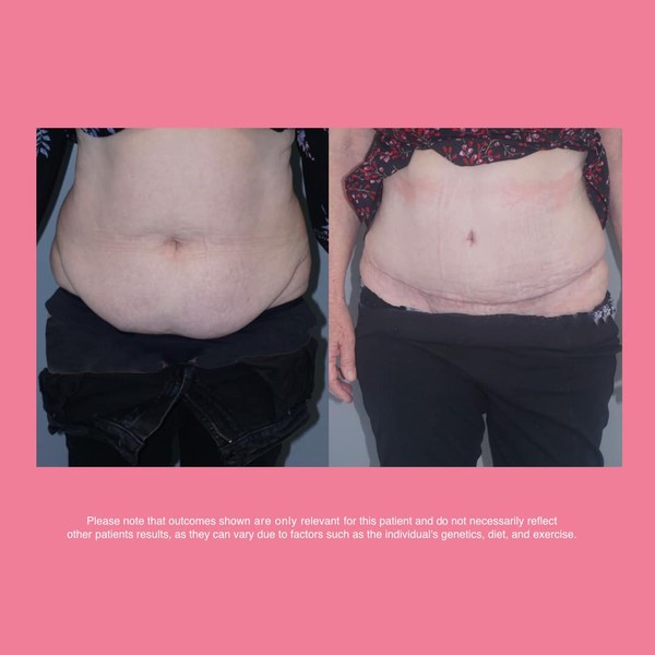 Tummy Tuck Perth | Abdominoplasty | Dr David Colbert