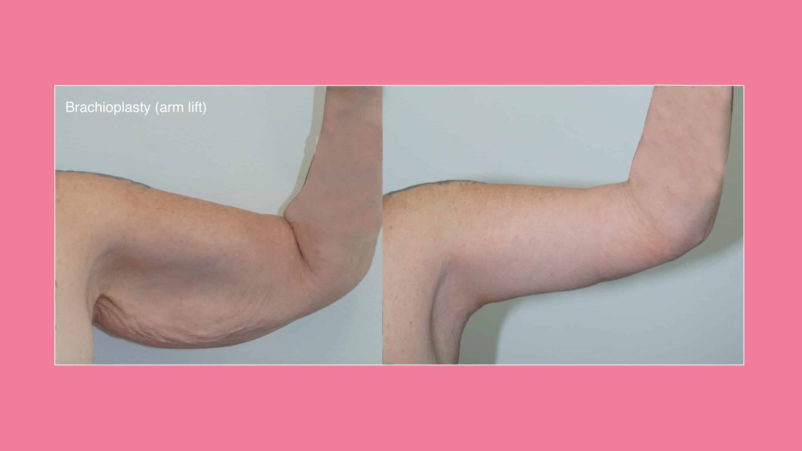 Brachioplasty | David Colbert